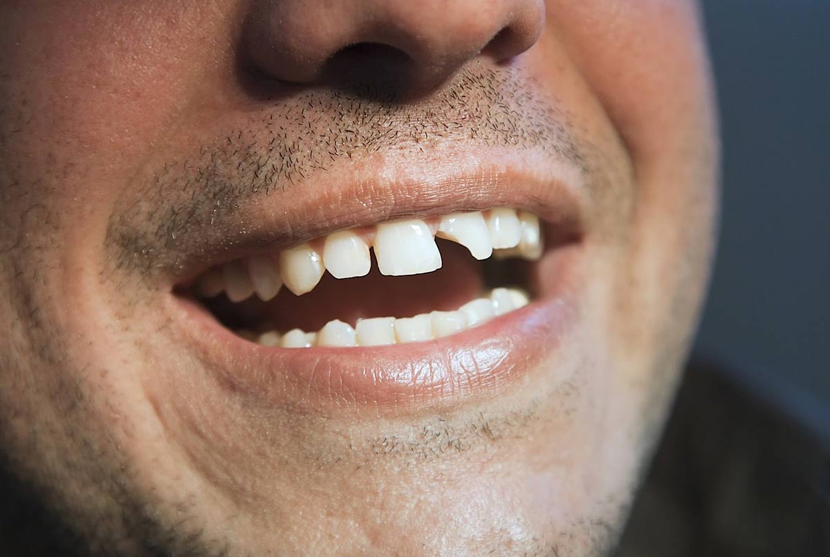 Best Treatment For A Cracked Tooth Elegantdentcare Blog