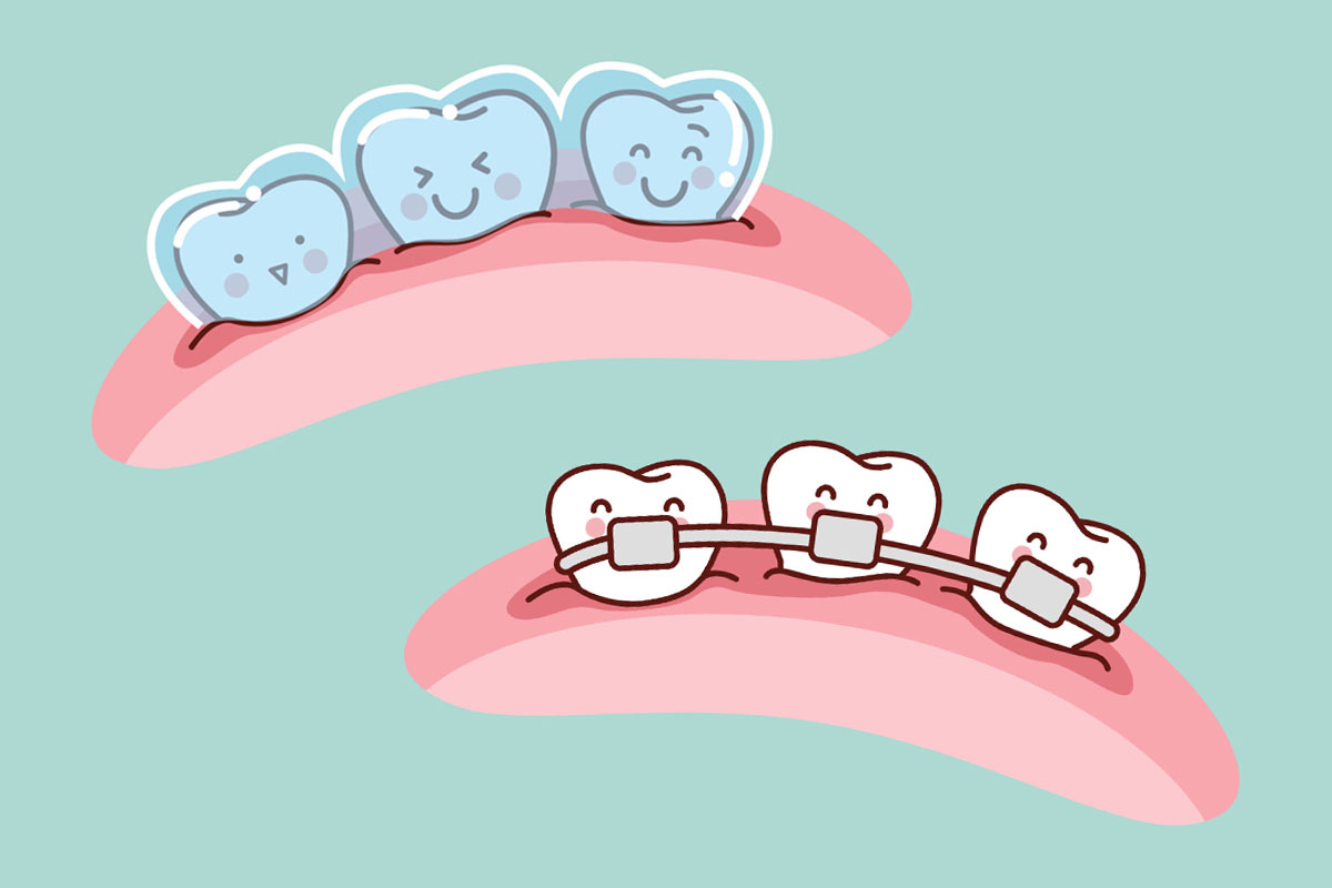 Invisalign vs. Braces, Which Is Best? (The Pros and Cons of Each ...