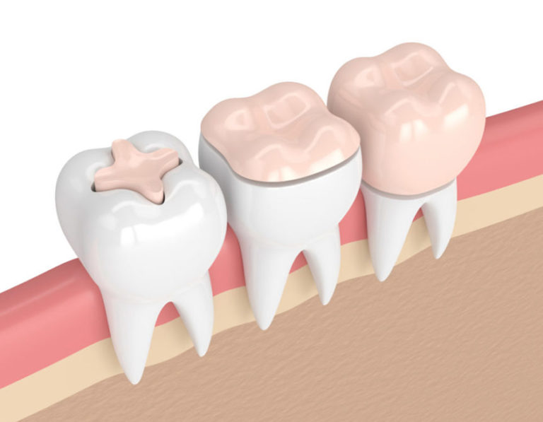 Full List Of Dental Services Types | Elegantdentcare Blog